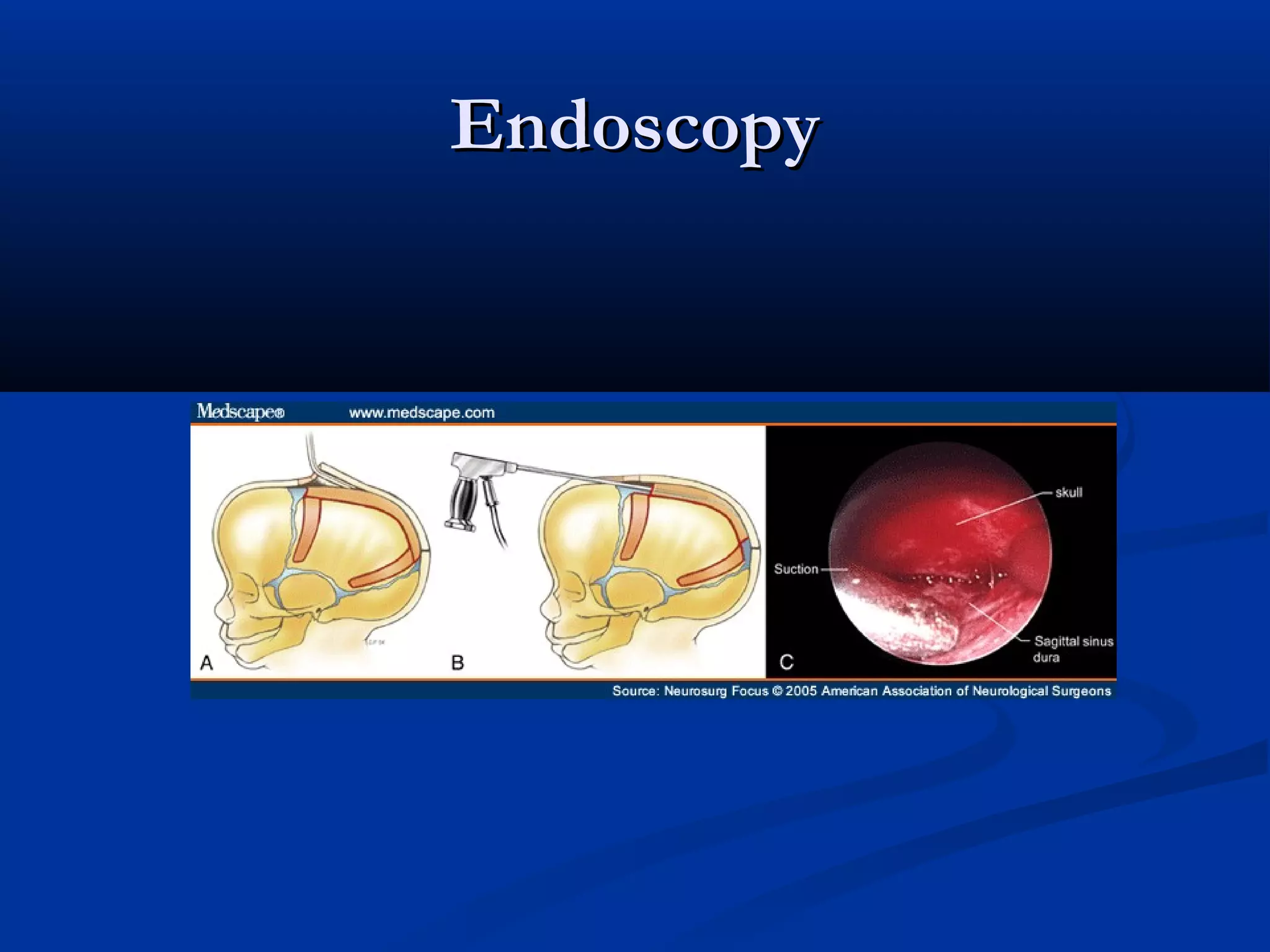 Craniostenosis | PPT