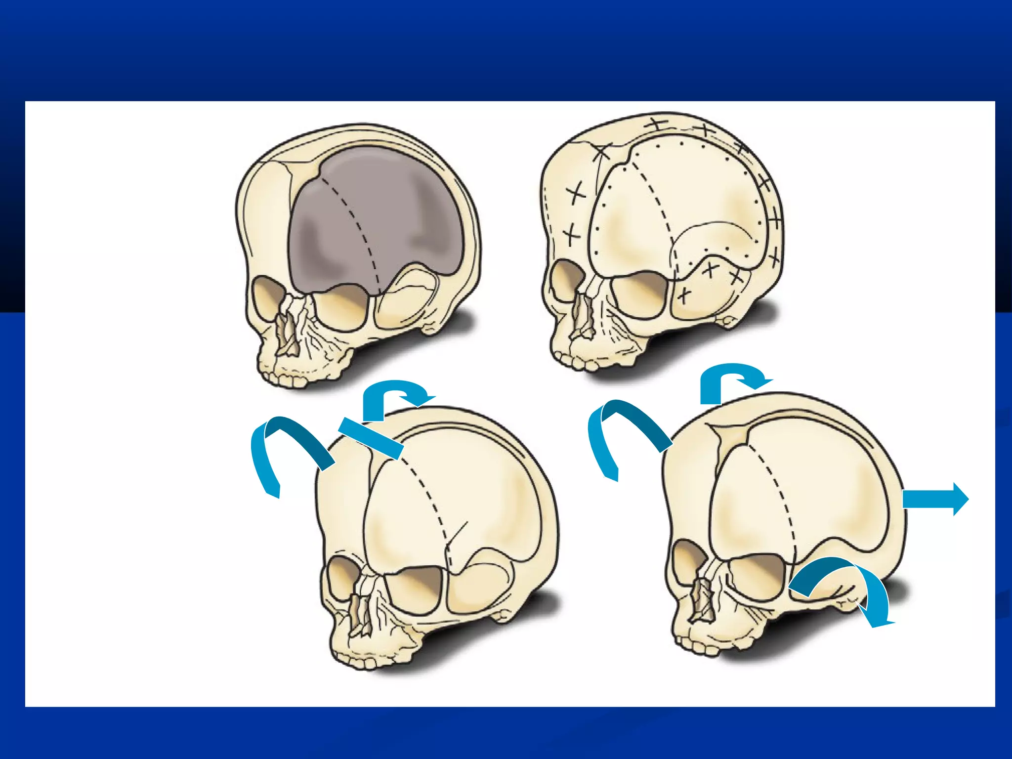 Craniostenosis | PPT