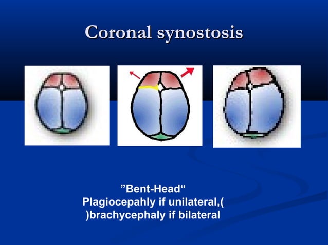 Craniostenosis | PPT