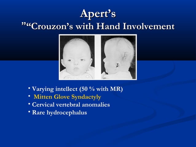 Craniostenosis | PPT