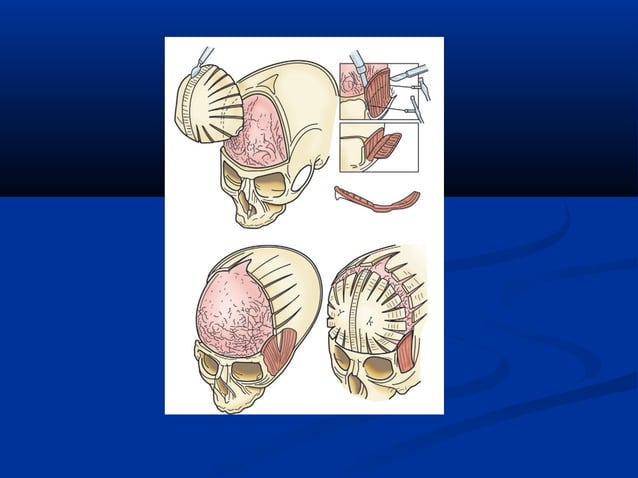 Craniostenosis | PPT