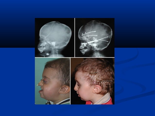 Craniostenosis | PPT