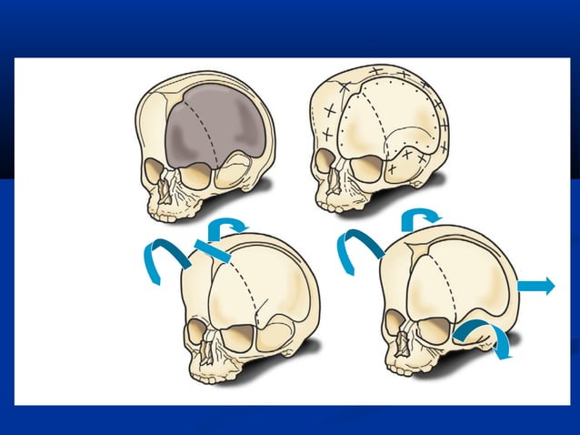 Craniostenosis | PPT