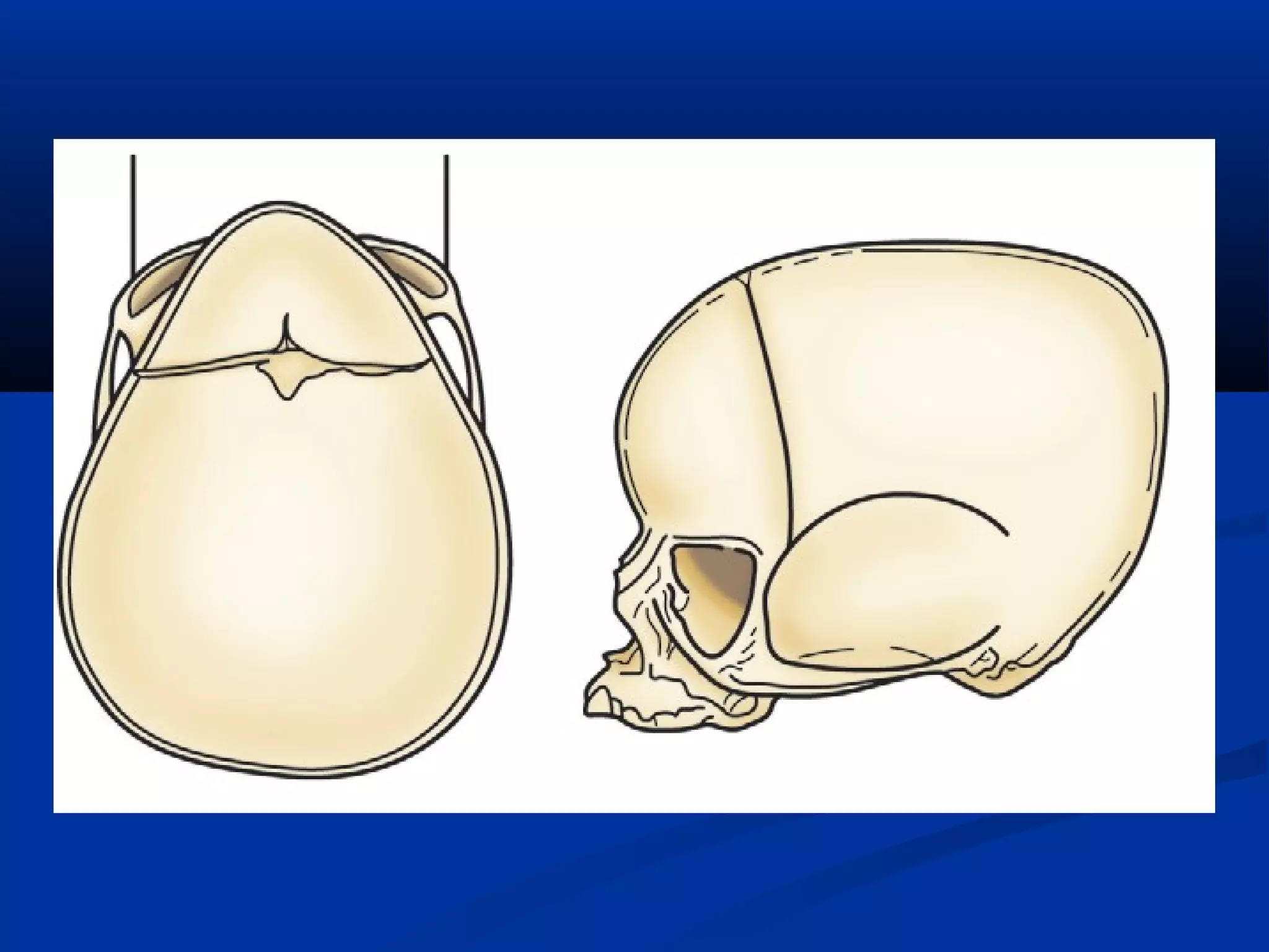 Craniostenosis | PPT
