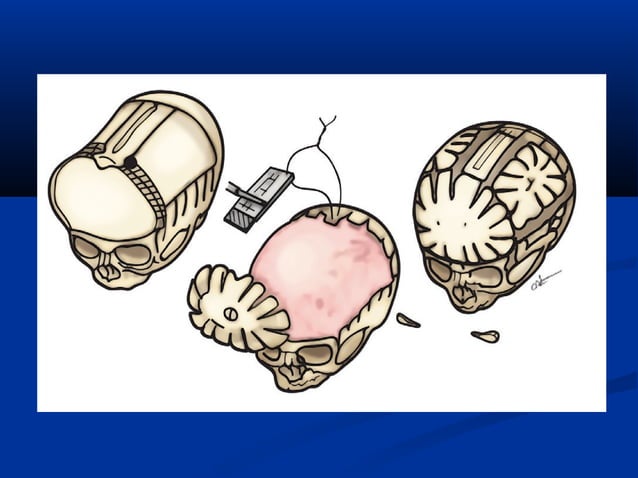 Craniostenosis | PPT
