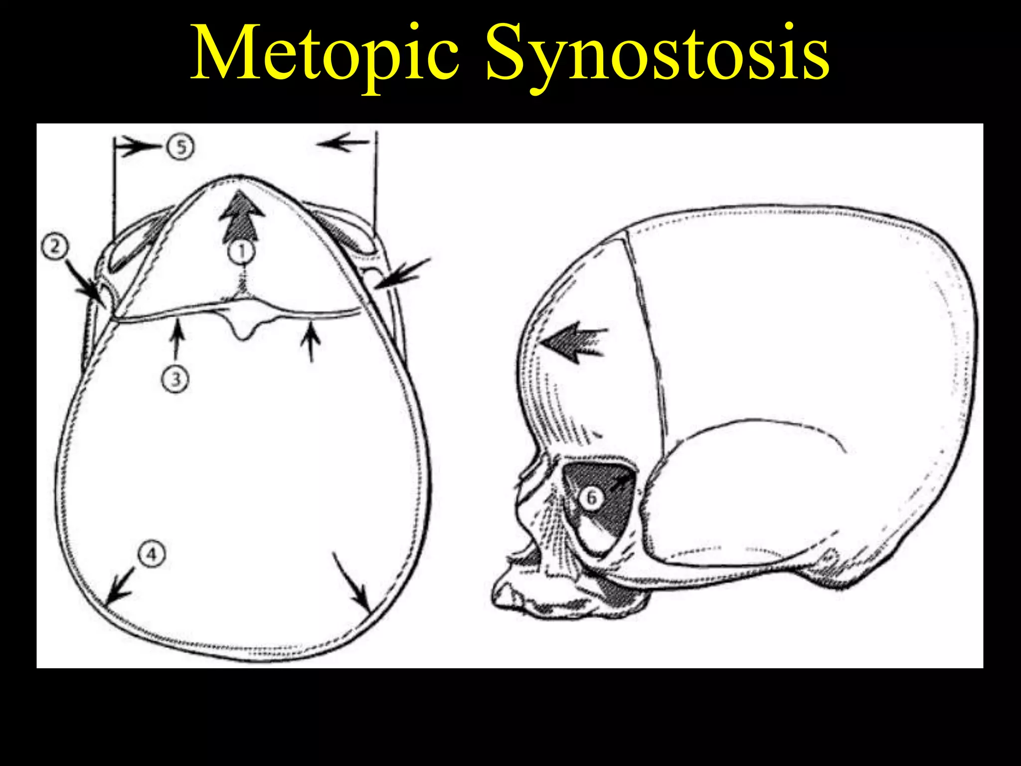 Craniosynostosis | PPTX