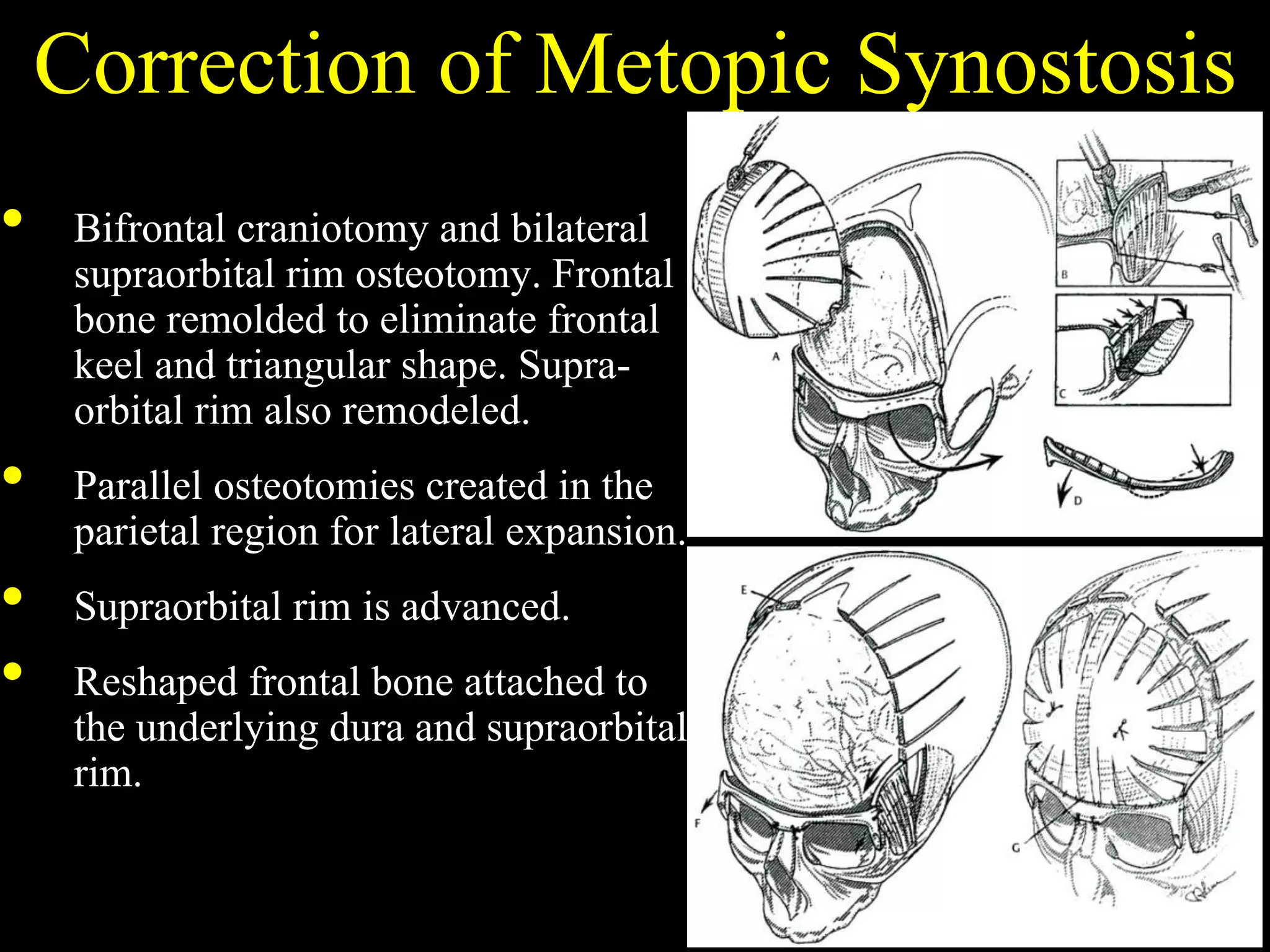 Craniosynostosis | PPTX