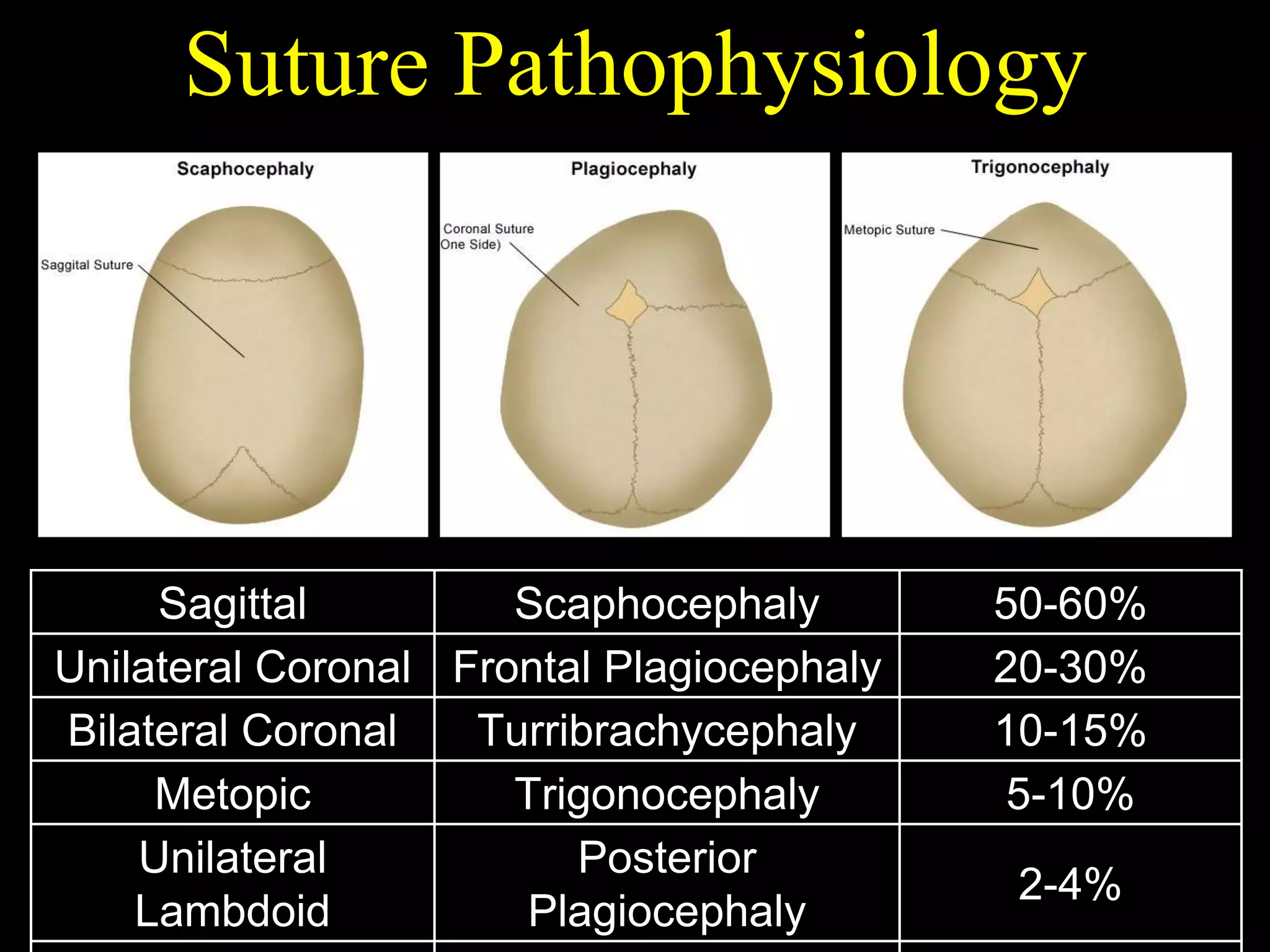Craniosynostosis | PPTX