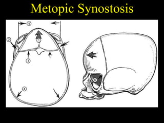 Craniosynostosis | PPTX