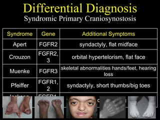 Craniosynostosis | PPTX