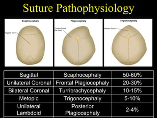 Craniosynostosis | PPTX
