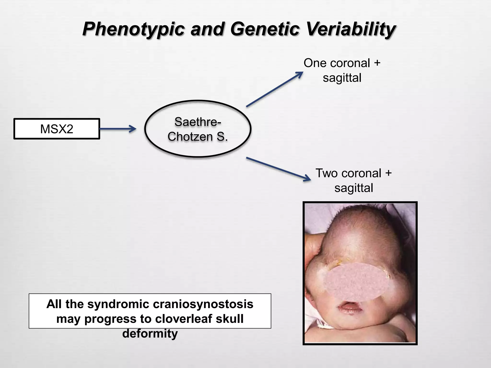 A Radiological Approach to Craniosynostosis | PPTX
