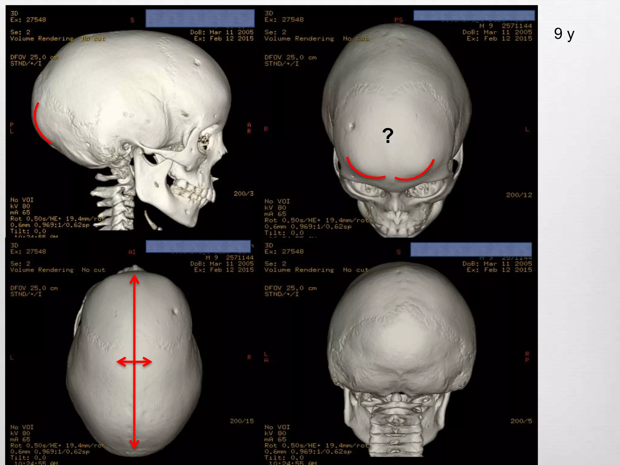 A Radiological Approach to Craniosynostosis | PPTX