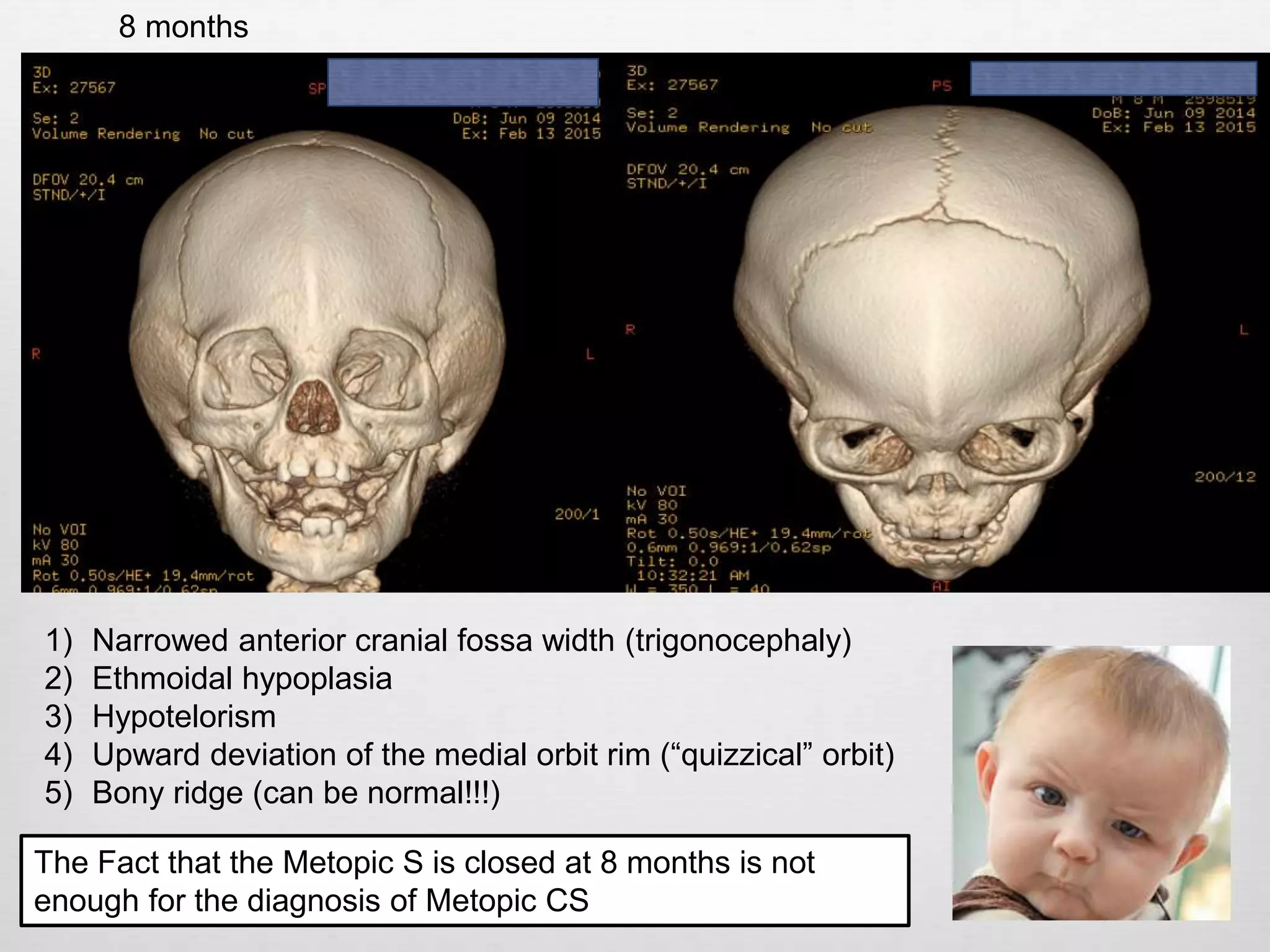 A Radiological Approach to Craniosynostosis | PPTX