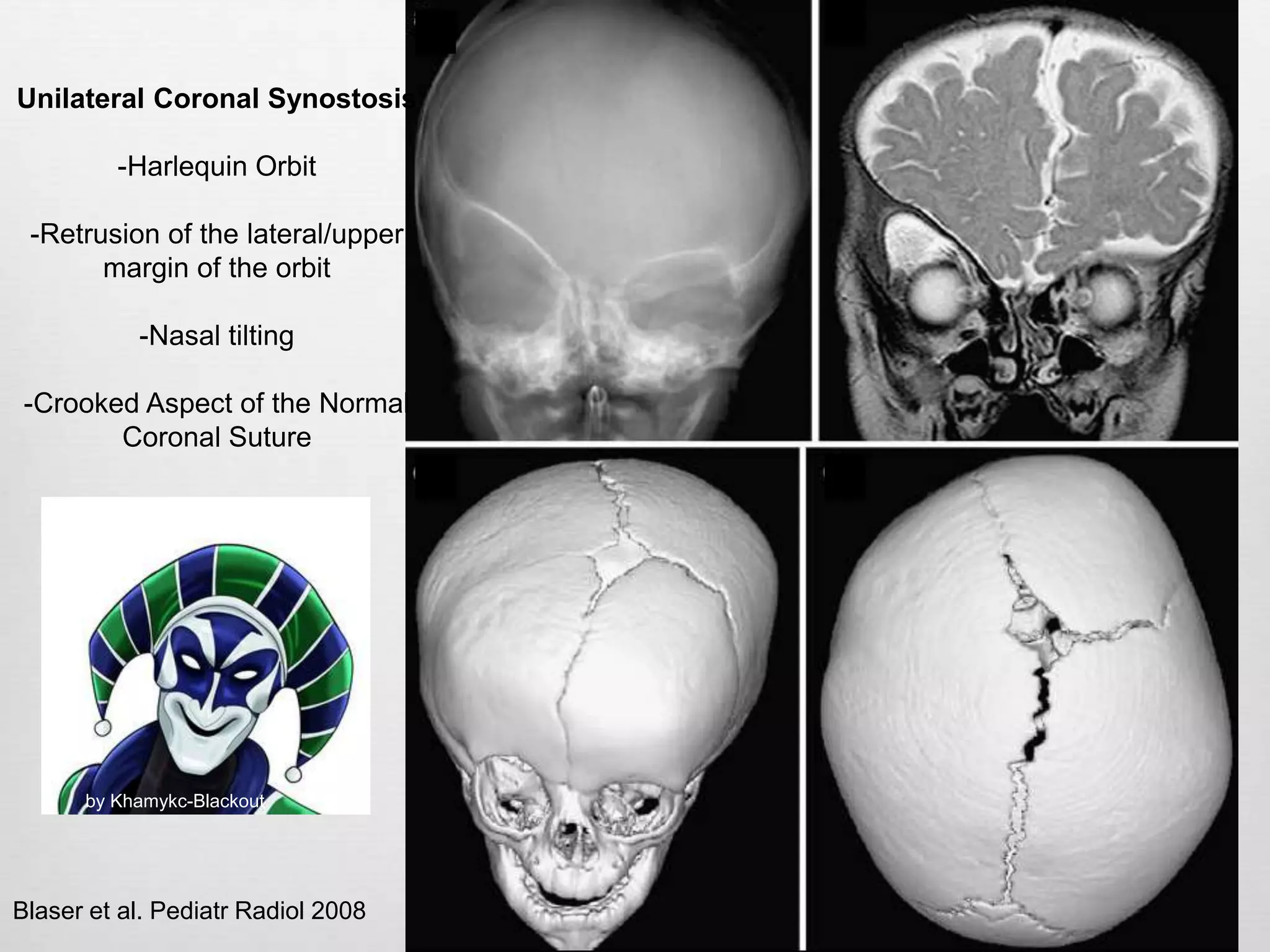 A Radiological Approach to Craniosynostosis | PPTX