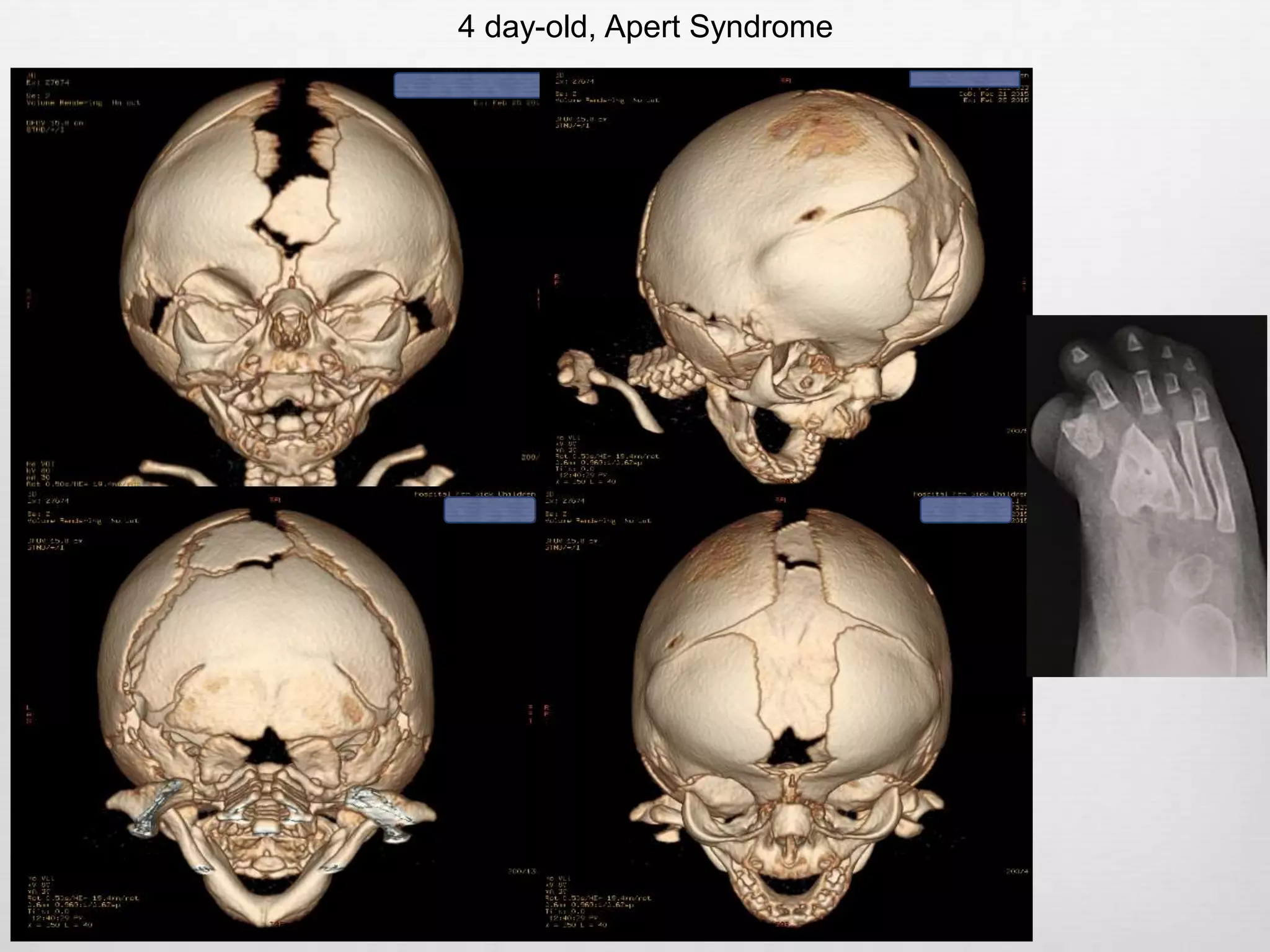 A Radiological Approach to Craniosynostosis | PPTX