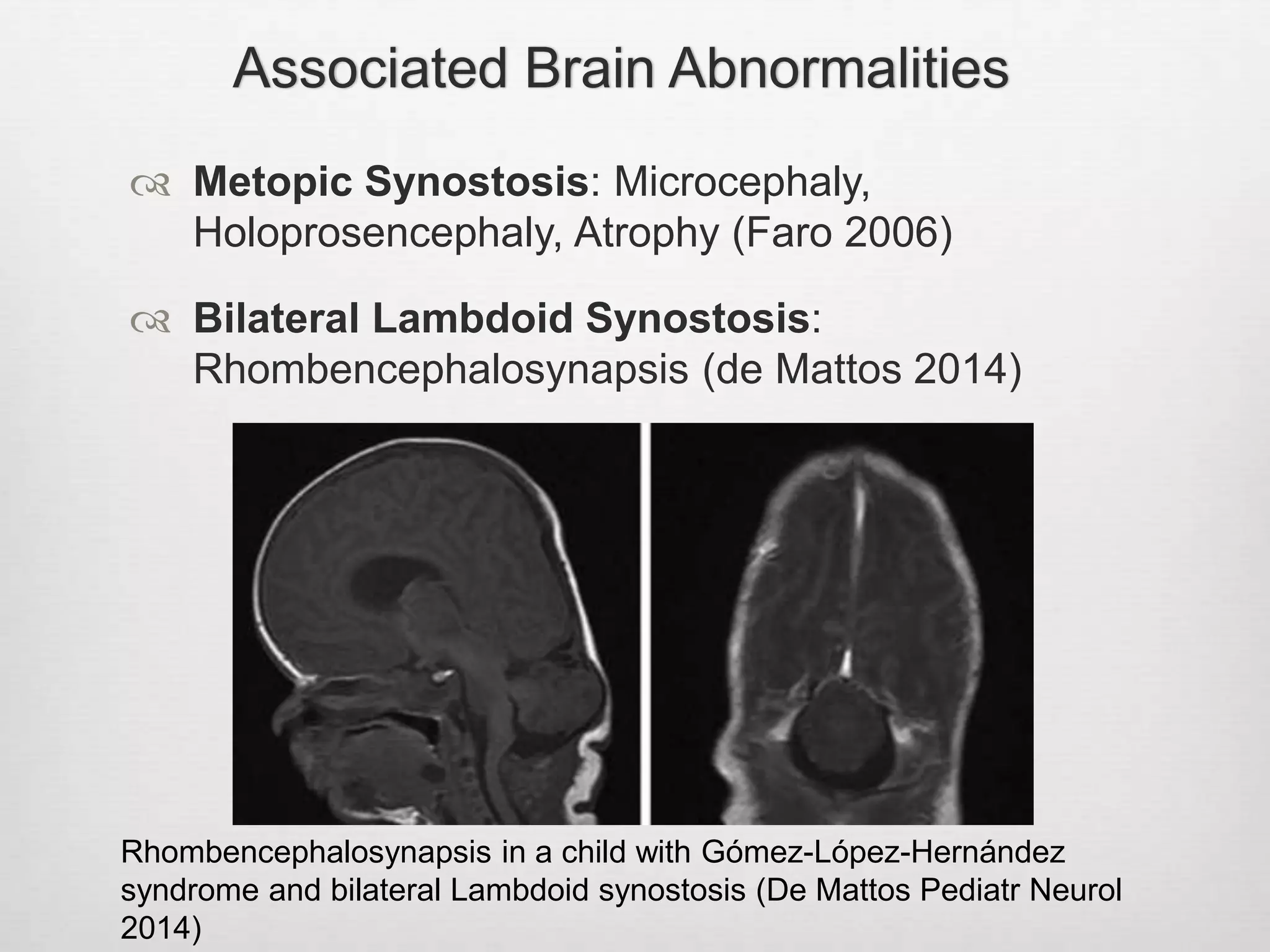A Radiological Approach to Craniosynostosis | PPTX