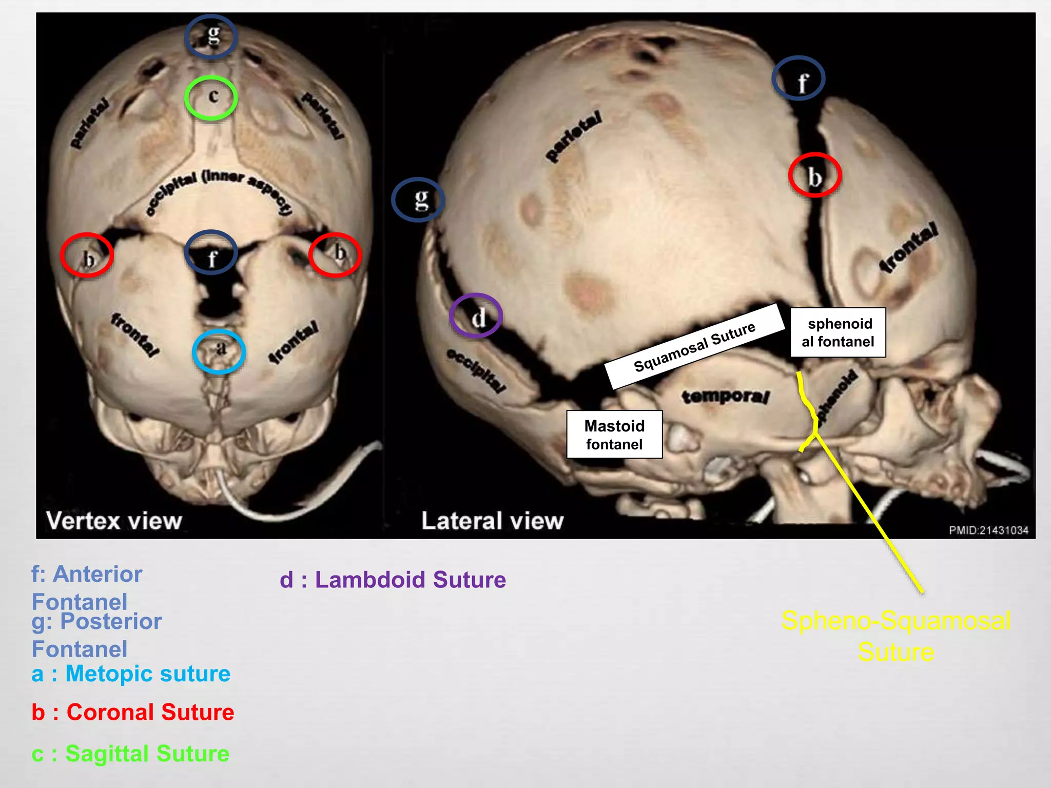 A Radiological Approach to Craniosynostosis | PPTX