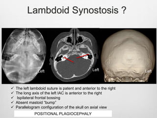 Lambdoid Synostosis