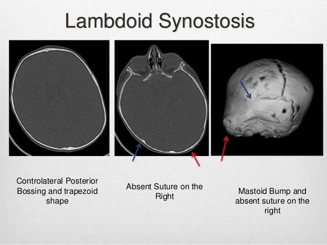 A Radiological Approach to Craniosynostosis
