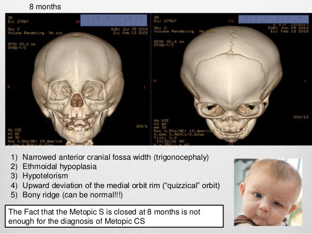 A Radiological Approach to Craniosynostosis