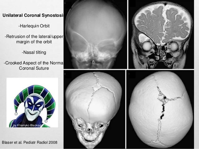 A Radiological Approach to Craniosynostosis