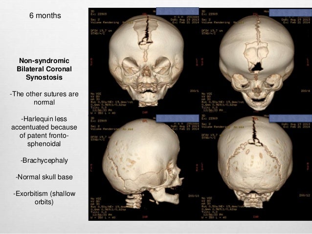 A Radiological Approach to Craniosynostosis