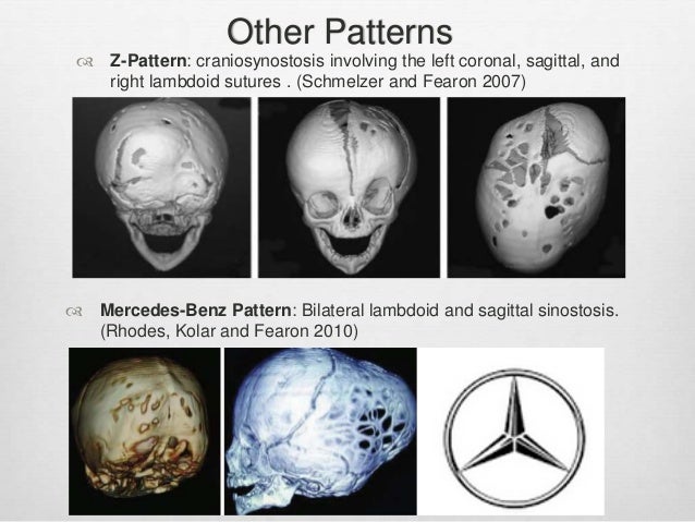 A Radiological Approach to Craniosynostosis
