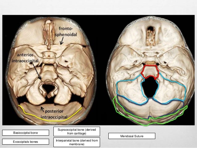 A Radiological Approach to Craniosynostosis