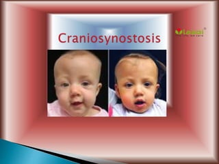 Craniosynostosis | PPTX