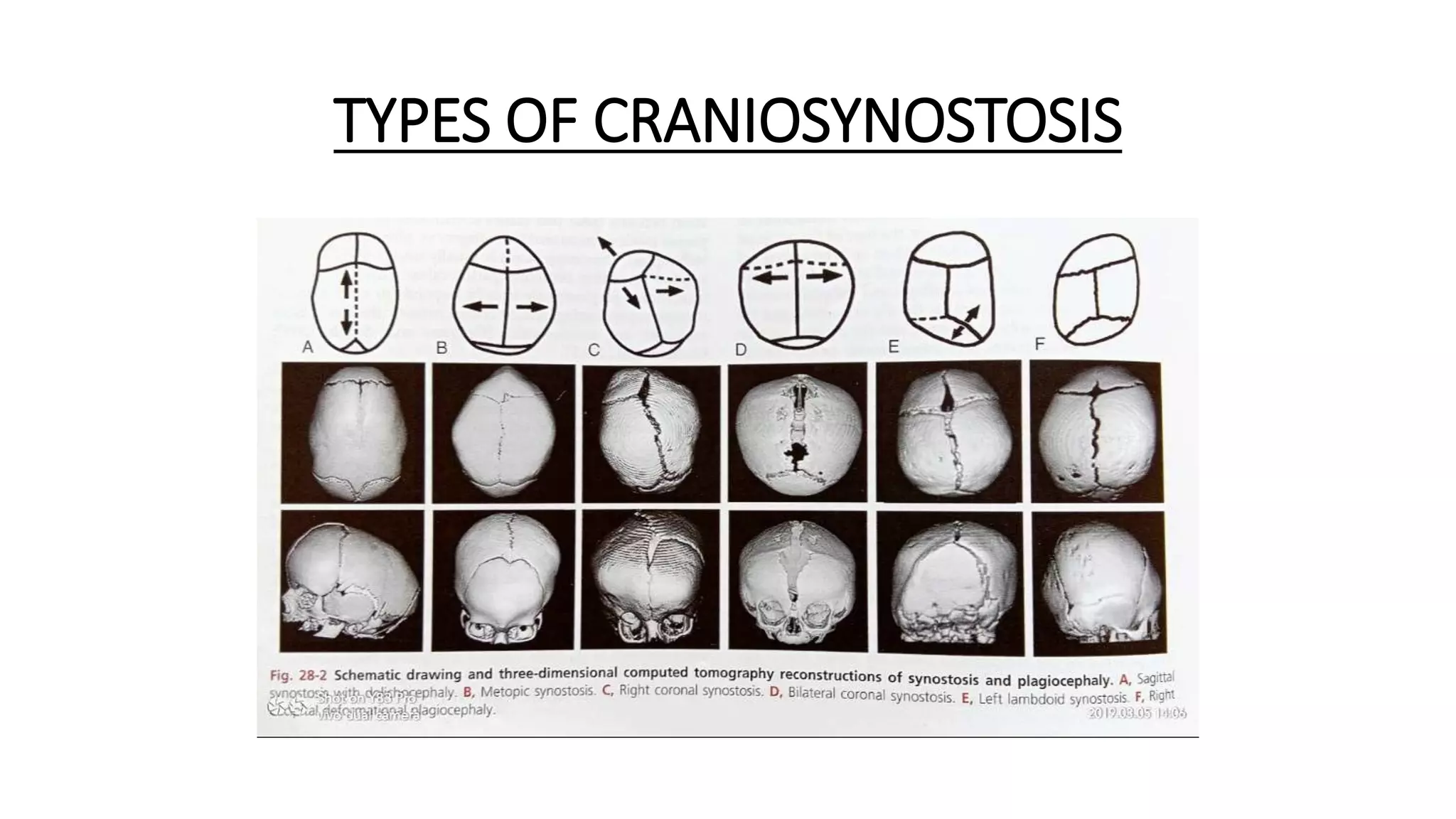 CRANIOSYNOSTOSIS CRANIO SYNOSTOSIS | PPTX