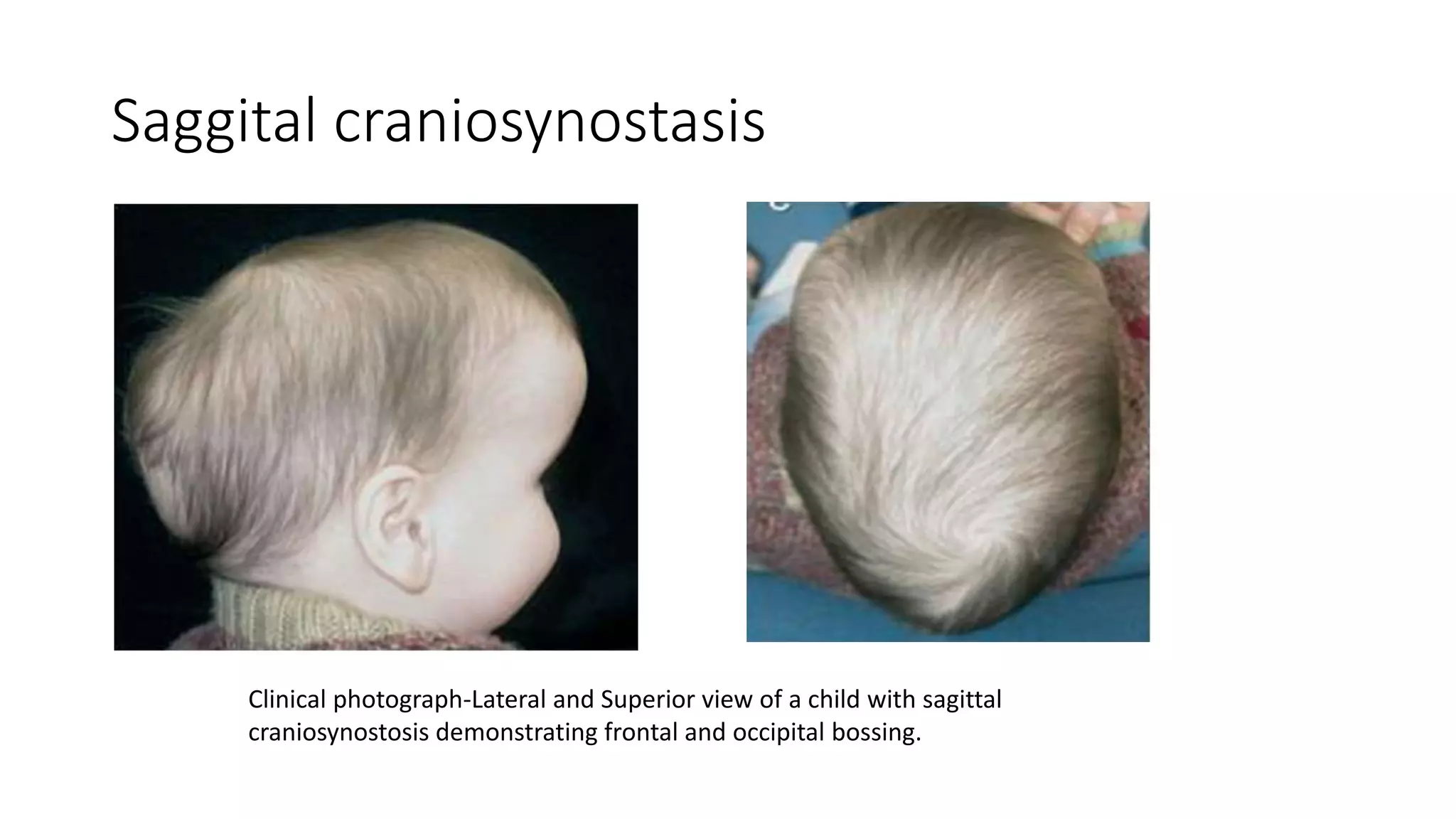 CRANIOSYNOSTOSIS CRANIO SYNOSTOSIS | PPTX