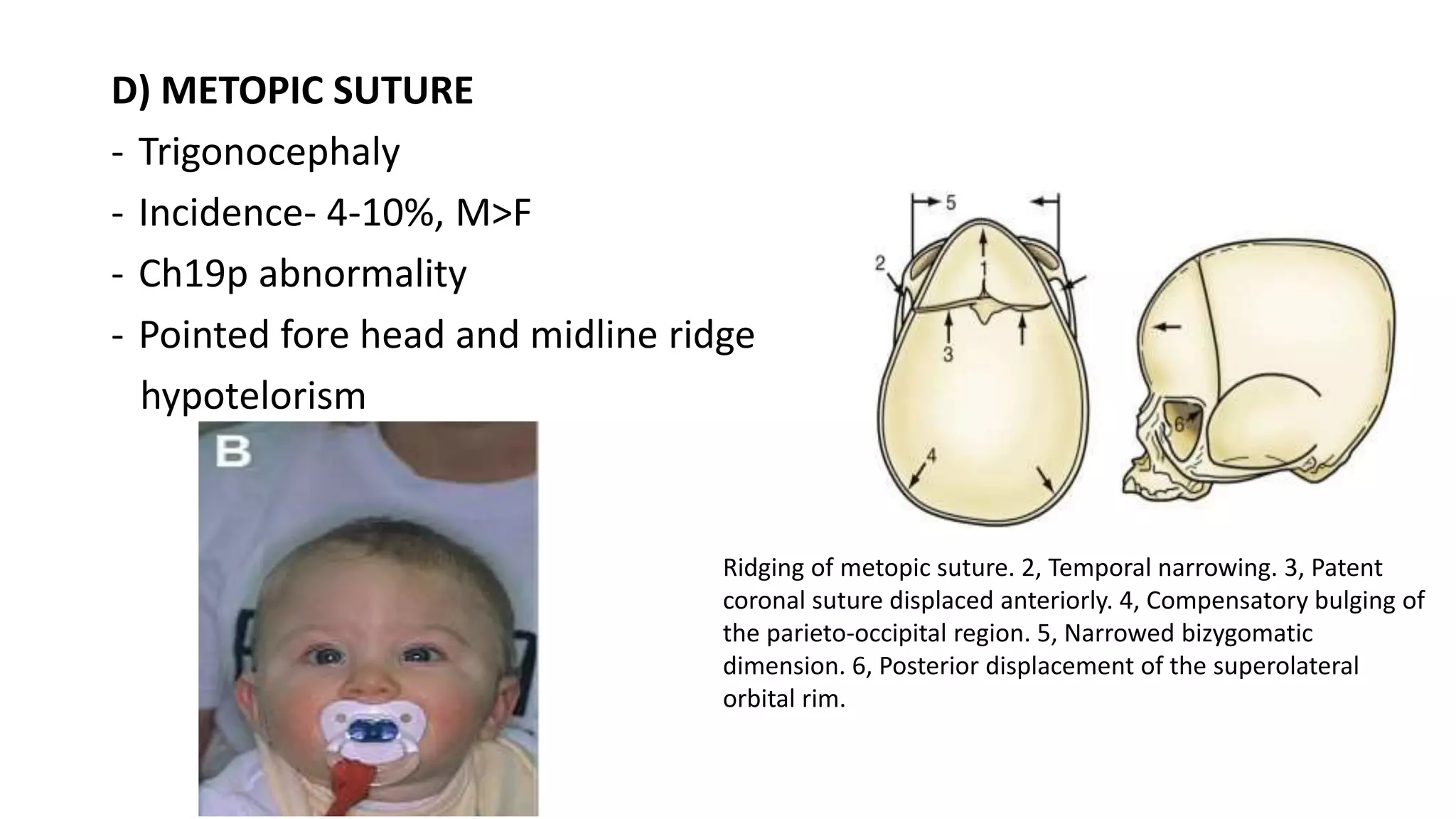 CRANIOSYNOSTOSIS CRANIO SYNOSTOSIS | PPTX