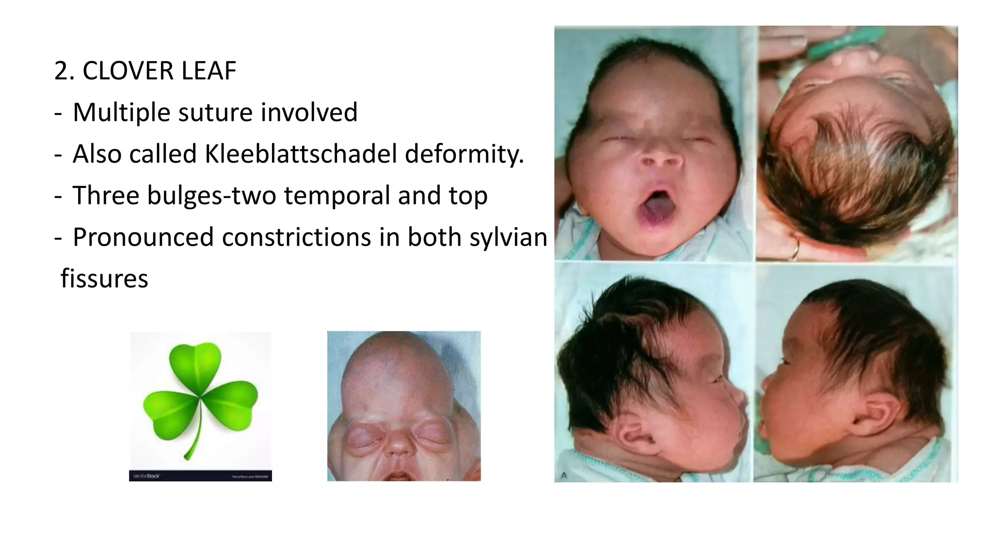 CRANIOSYNOSTOSIS CRANIO SYNOSTOSIS | PPTX