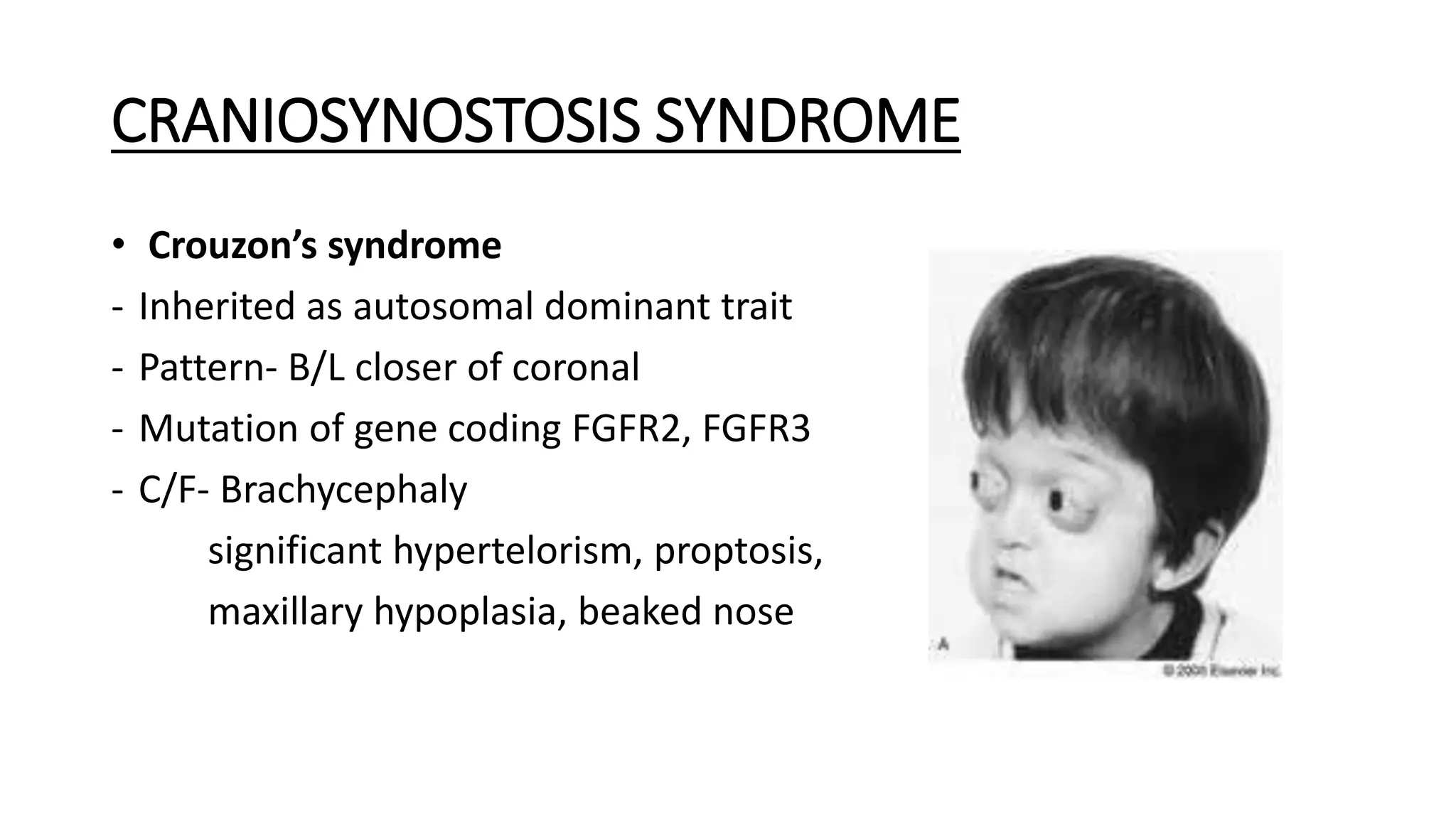 CRANIOSYNOSTOSIS CRANIO SYNOSTOSIS | PPTX
