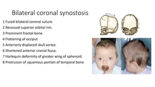 CRANIOSYNOSTOSIS CRANIO SYNOSTOSIS | PPTX