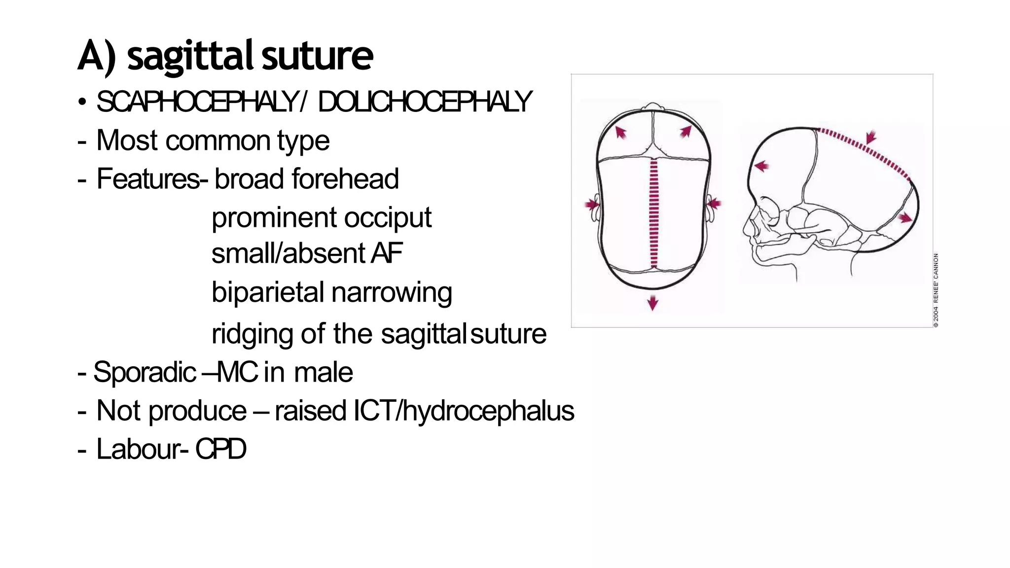 Craniosynostosis | PPTX