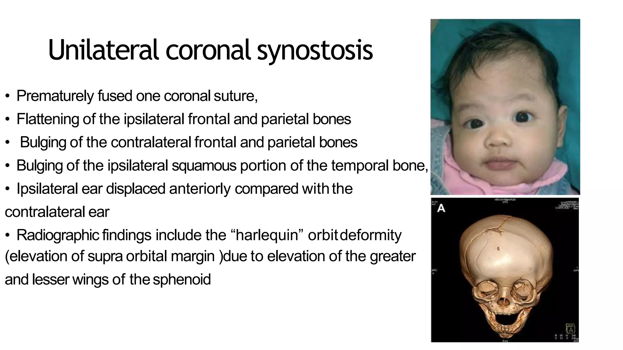 Craniosynostosis | PPTX