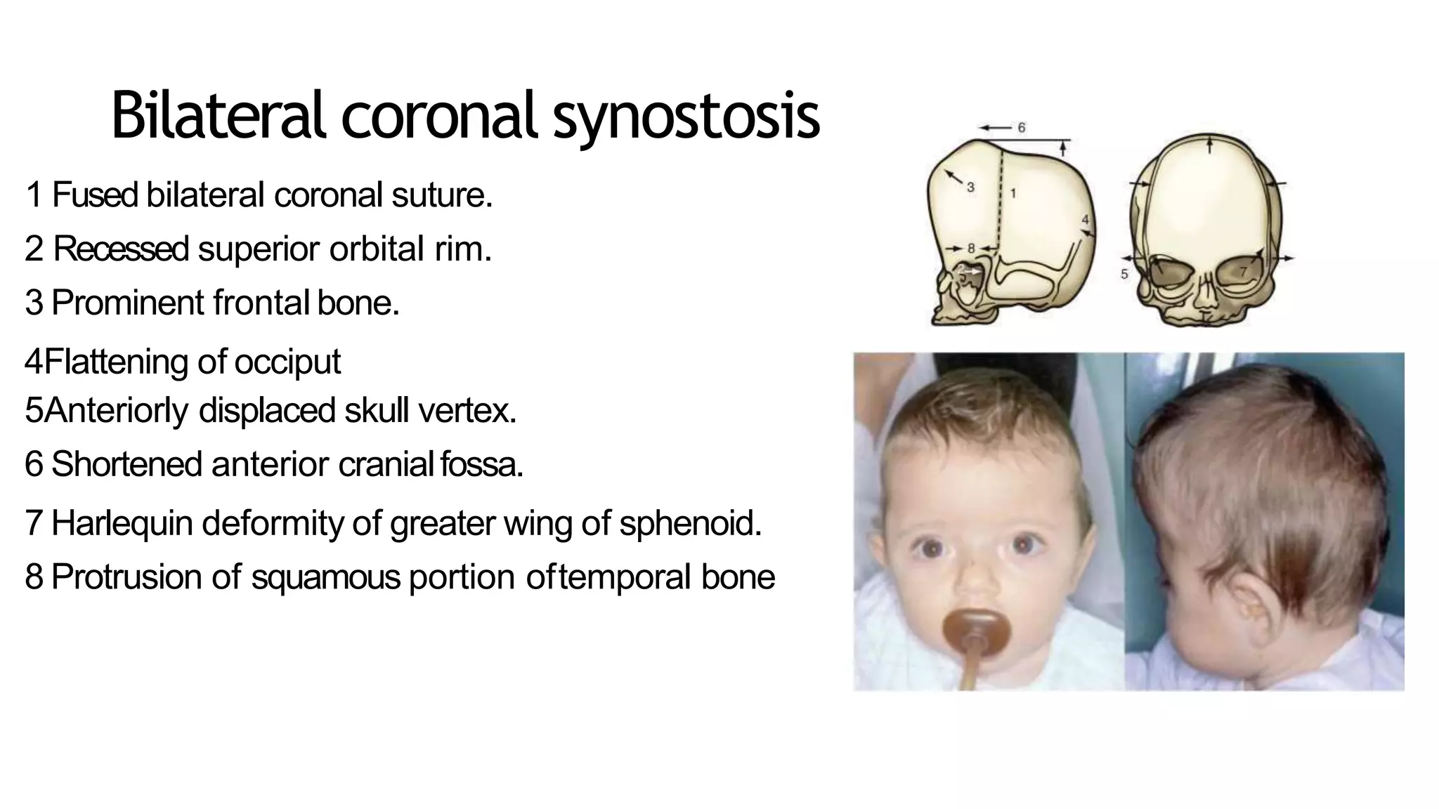 Craniosynostosis | PPTX