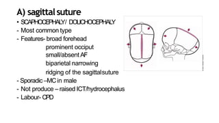 Craniosynostosis | PPTX