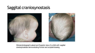Craniosynostosis | PPTX