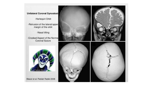 Craniosynostosis | PPTX | Ear, Nose and Throat Conditions | Diseases ...