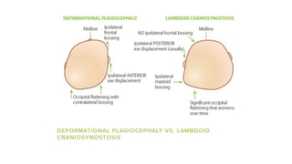 Craniosynostosis | PPTX