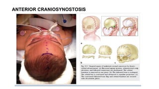 Craniosynostosis | PPTX