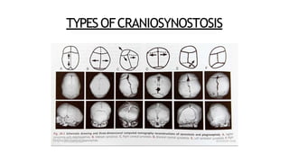Craniosynostosis | PPTX