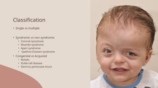 non syndromic craniosynostosis and deformational plagicephaly.pptx