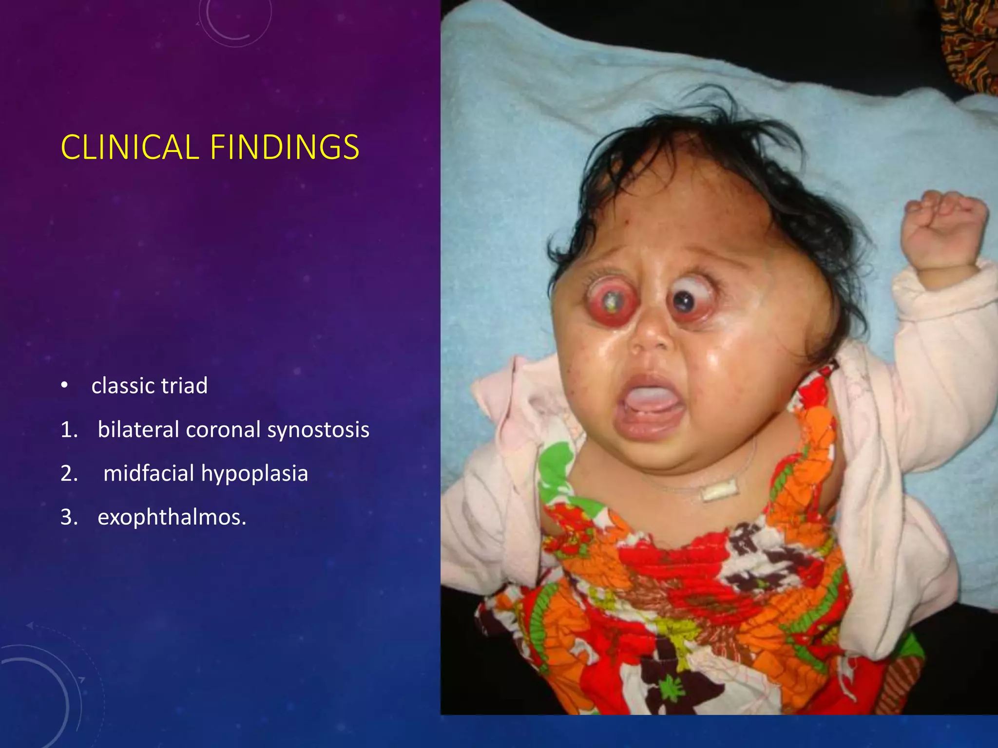 Craniosynostosis | PPTX