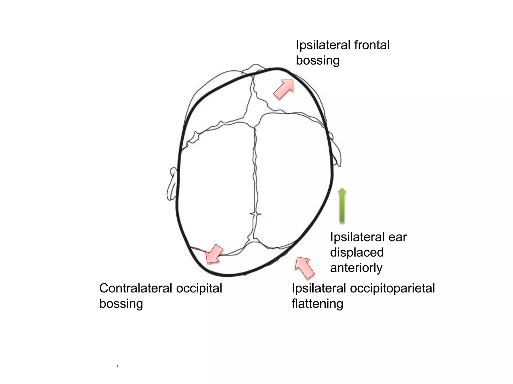 Craniosynostosis | PPTX