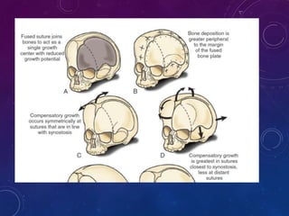 Craniosynostosis | PPTX