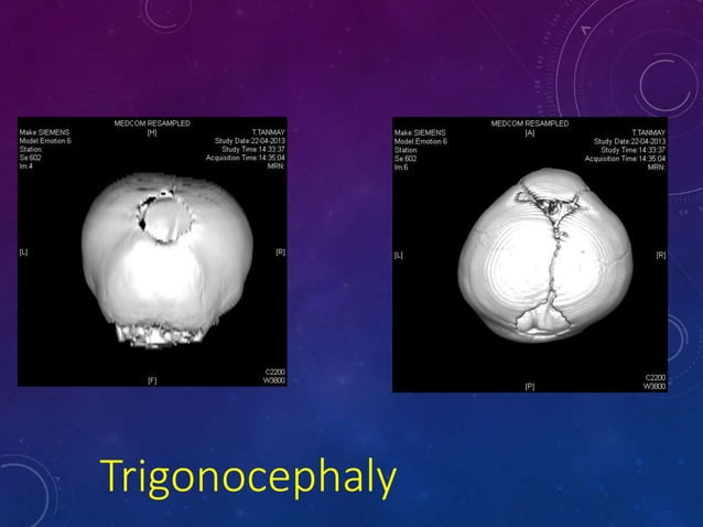 Craniosynostosis | PPTX | Cosmetic Medical Services | Medical Health
